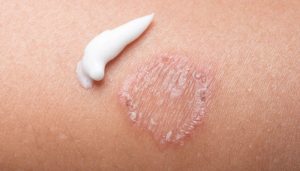 Viral Infections Of Skin - Causes, Types, And Treatment